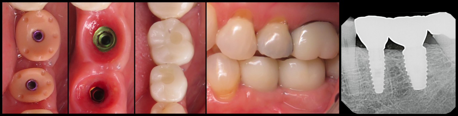Resources | Anatotemp Anatomic Dental Implant Healing Abutment