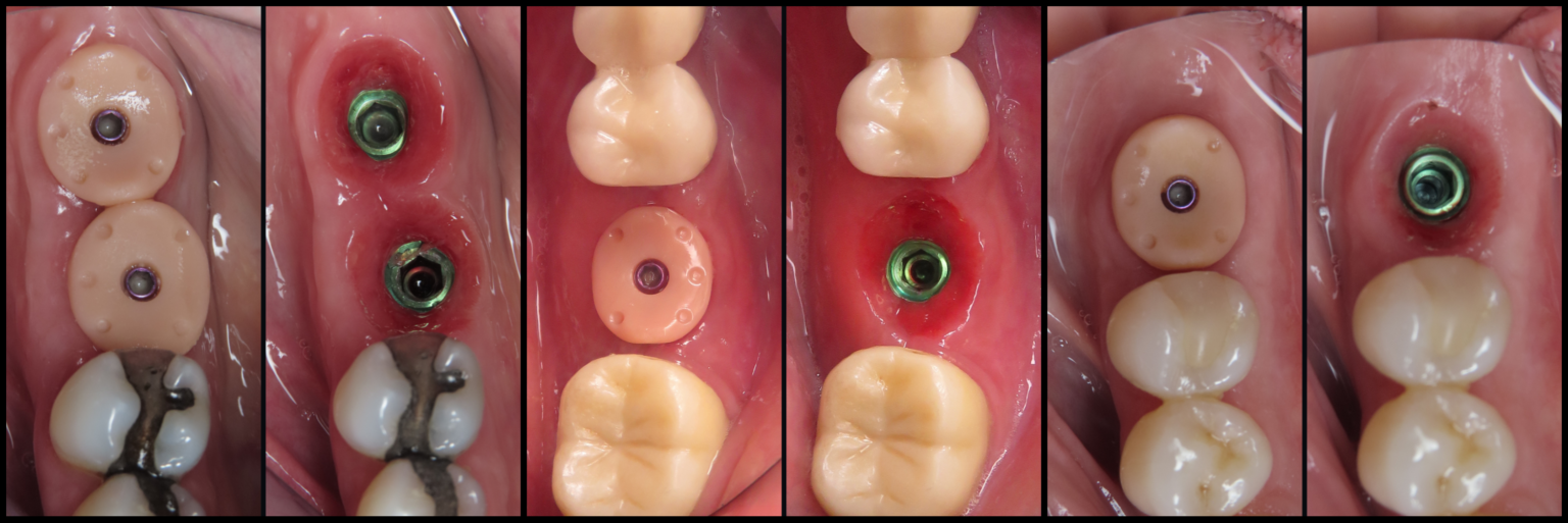 Resources | Anatotemp Anatomic Dental Implant Healing Abutment